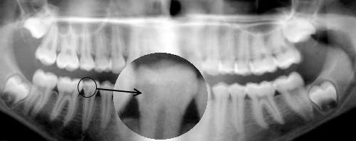 ENDODONTIE | FICHE Inlay core